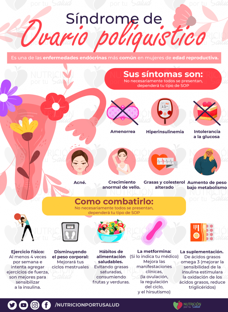 ¿Qué es el síndrome ovario poliquístico? : Explicación Médica